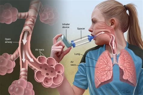 How To Treat Asthma Attacks Without An Inhaler By Preventing Them Instead