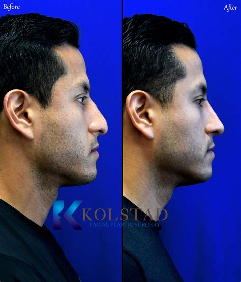 Hispanic Rhinoplasty San Diego Dr Kolstad San Diego Facial Plastic