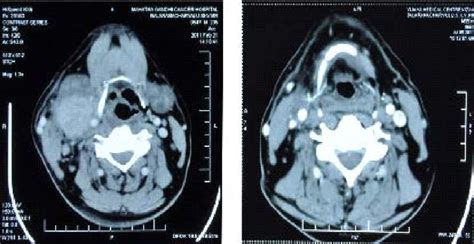 A Pretreatment Cect Of Neck Showing Right Upper Cervical Lymph Node Download Scientific