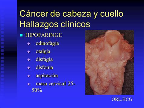 Cáncer De Hipofaringe