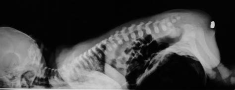 Cross Table Lateral Radiograph