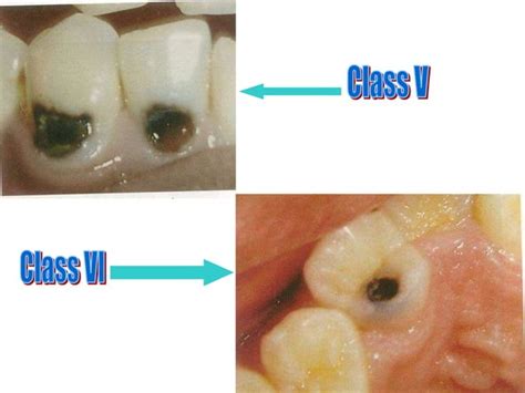 Dental Caries Classificationppt