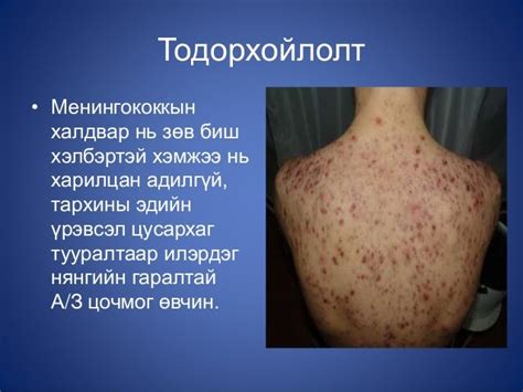 гар хөл амны өвчин