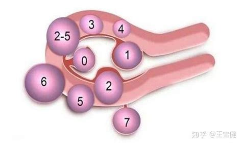 子宫肌瘤的分型 知乎