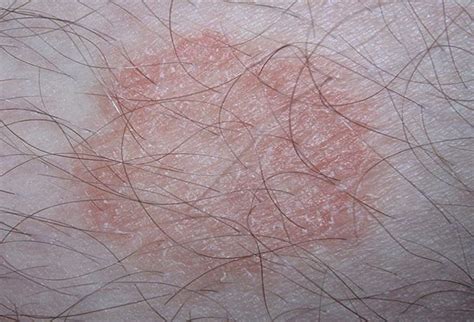 14 Rashes You Need To Know Common Dermatologic Diagnoses