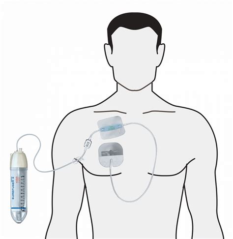 Surefuser™ Nipro Surefuser™ Nipro