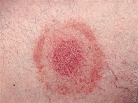 what does a bullseye from a tick bite look like