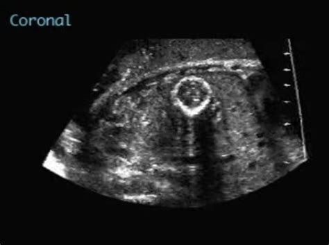 Intestinal Duplication Ultrasoundpaedia