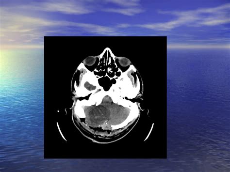 Decompressive Craniectomy And Its Managemnet Ppt