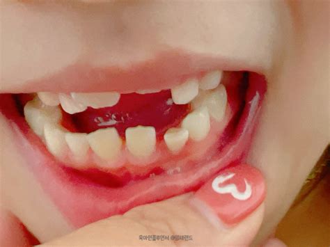 유치 빠지는 순서 앞니 치아 흔들림 어금니 나는 시기 네이버 블로그