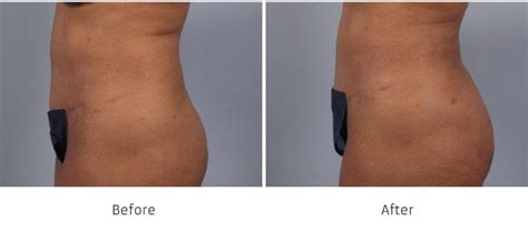 Brazilian Butt Lift Cosmetic Surgery Allure Medical