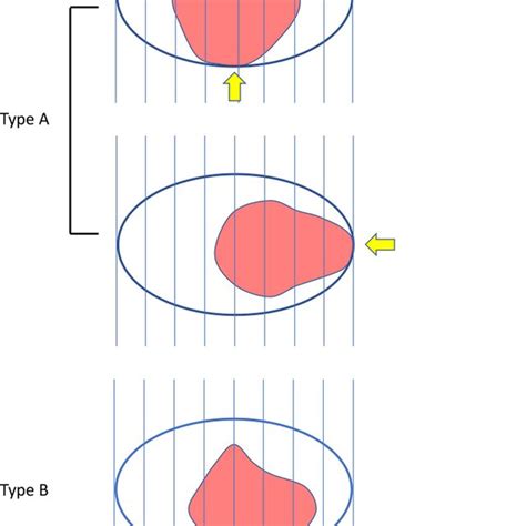 Definition Of Local Recurrence After Endoscopic Submucosal Dissection