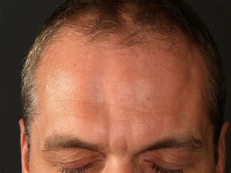 Linear Scleroderma Forehead