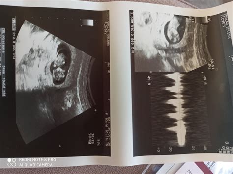 Разчитане на снимка от коремен ехограф Бъдещи майки Мнения от Bg Mamma