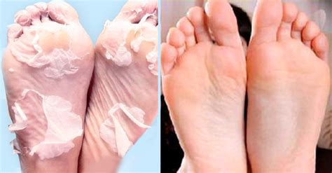 მარტივი საშინაო მეთოდი ქუსლებიდან გარქოვანებული კანის მოსაშორებლად