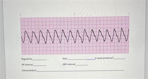 Solved Regularity Rate P Wave Presence Pr Interval Qrs