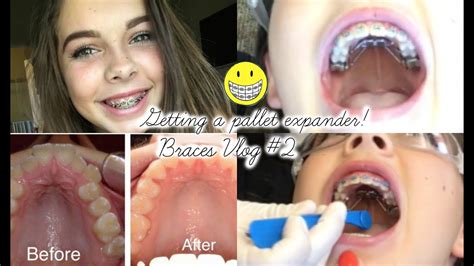 Braces Vlog 2 Getting A Pallet Expander Youtube
