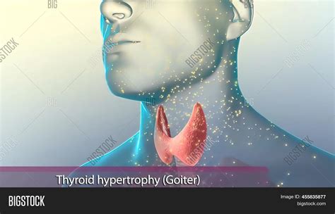 Hyperthyroidism When Image And Photo Free Trial Bigstock