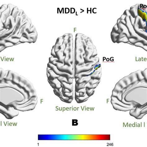 Statistical Difference Of Clustering Coefficient Of Individual Brain