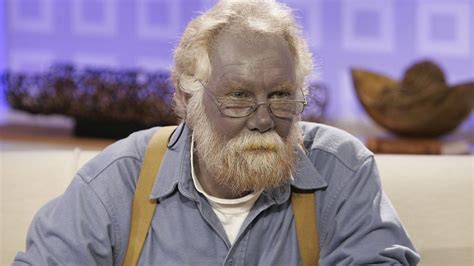 Argyria The Rare Disease That Turns People Blue Live Science