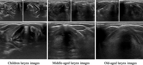Figure 1 From Larynx Ultrasound Image Stitching Based On Multiconstraint Super Pixel Feature
