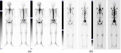 Skeletal Scintigraphy Image With A Normal B Abnormal Download Scientific Diagram