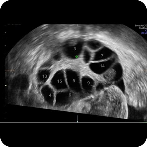 Herview Ultrasound