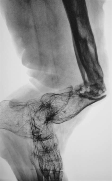 С диагнозом хронический остемиелит пациент направлен на рентгенографию костей голени