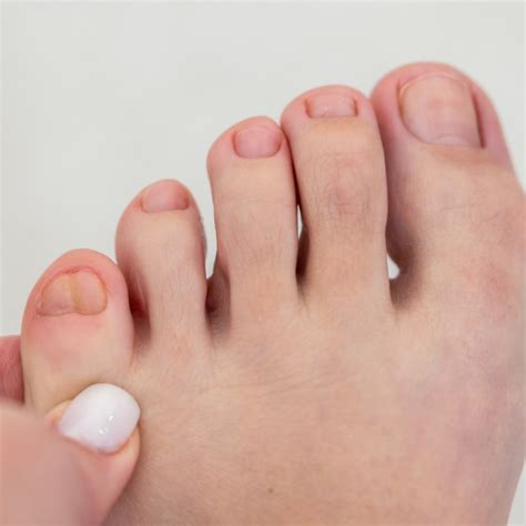 4 Common Toe Deformities And How To Treat Them