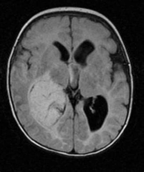 Choroid Plexus Carcinoma