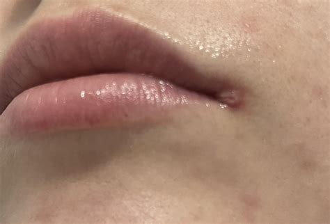 Angular Cheilitis Not Healing Its Been A Few Days Ive Used Aquaphor And Vaseline Do I Need