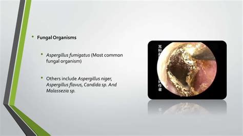 Malignant Otitis Externa Skull Base Osteomyelitis Pptx