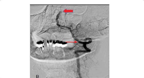 B Left Vertebral Artery Injection Demonstrating Complete Occlusion Of Download Scientific