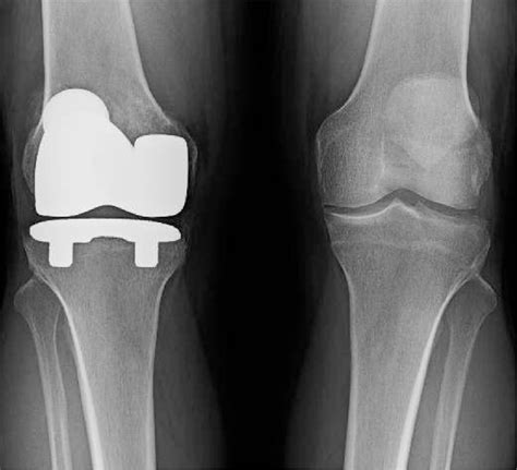Implanted Tm Tibia Component Download Scientific Diagram