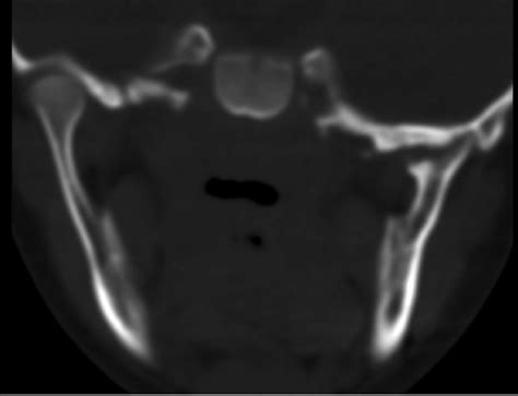 Right Side Shows The Normal Mandibular Condyle The Left Side Shows A Download Scientific