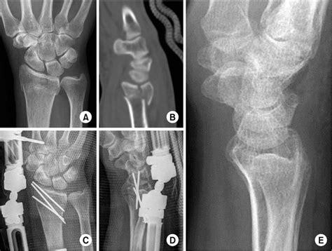A Anteroposterior Plain Radiograph Showing Intra Articular Distal Download Scientific Diagram