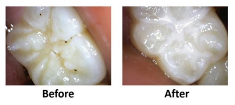 Fissure Sealant Application Mrgigi Dental Clinic