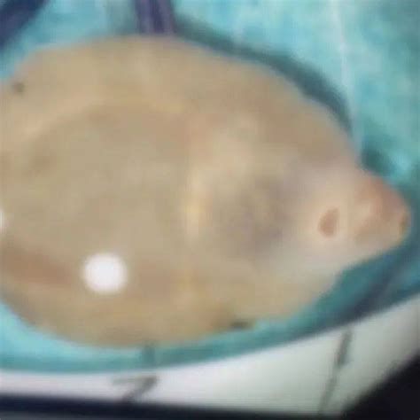 吓人一女子肝脏被吃掉三分之一竟是体内这条鱼 女士 医生 寄生虫