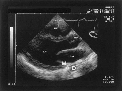 Echogenic Structures In The Left Atrioventricular Groove Diagnostic