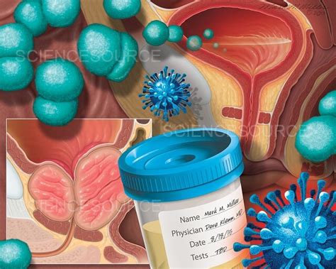 Photograph Dysuria Illustration Science Source Images