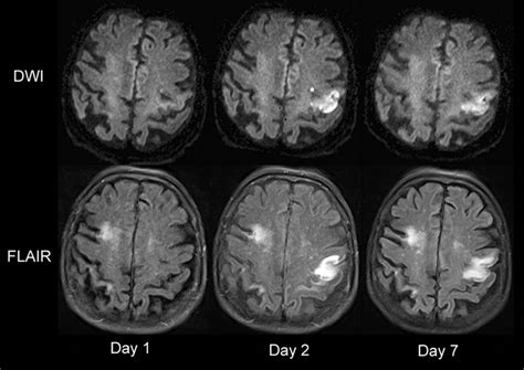 Complete Early Reversal Of Diffusion Weighted Imaging Hyperintensities After Ischemic Stroke Is