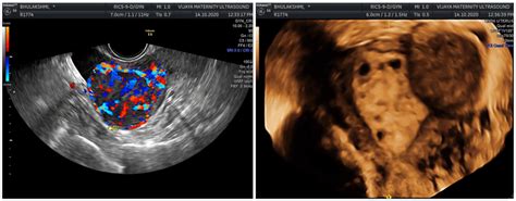 Ultrasound Image Showing A Fibroid With Increased Vascularity And 3d