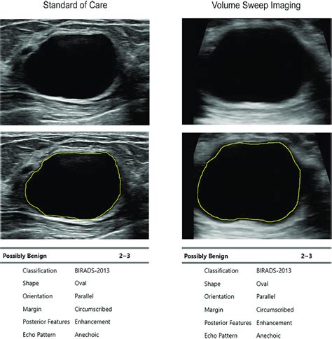 S Detect Interpretation Of A Cyst On Standard Of Care And VSI B Mode Download Scientific