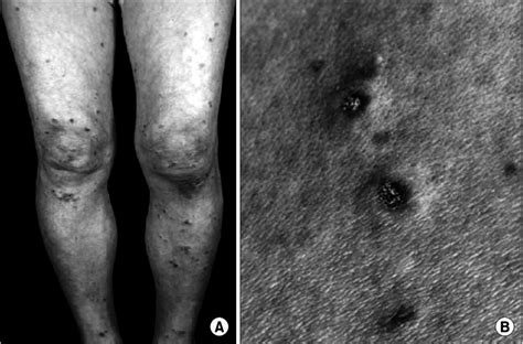 Photographs Of Skin Lesion Multiple Discrete Papules Are Seen On Both Download Scientific