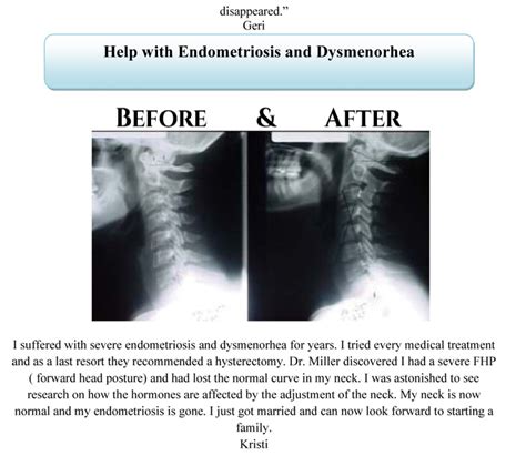Before And After X Rays Aspen Ridge Chiropractic