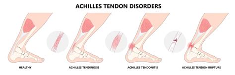 Achilles Tendon Tear Midwest Orthopaedics