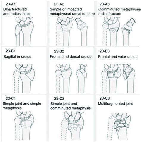 Ao Classification Ao Arbeitsgemeinschaftfür Osteosynthesefragen