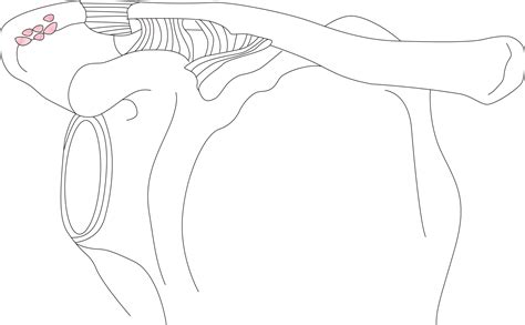 Acromioplasty Gloucestershire Shoulder Clinic