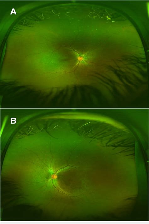 Dfe 6 Weeks F U Normal Looking Optic Discs Without Exudative Retinal Download Scientific