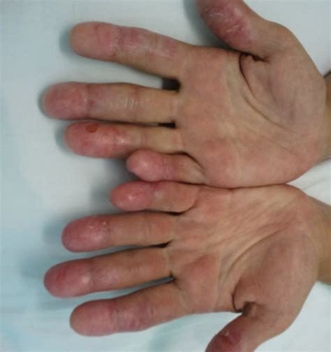 Sporotrichosis Diagnosis And Management Consultant360